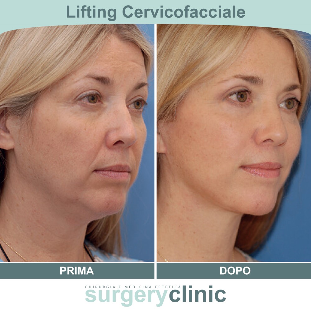 Lifting cervico facciale viso e collo