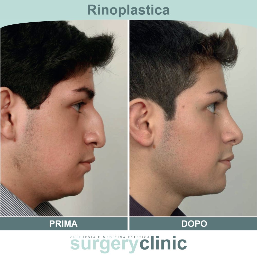 Rinoplastica migliora l'aspetto del naso