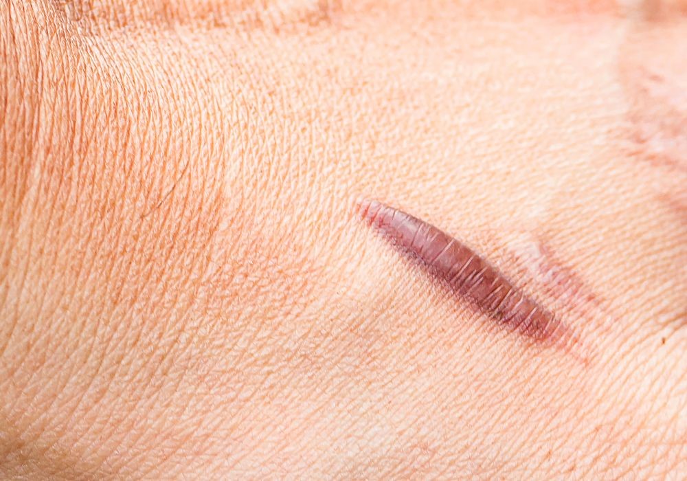 Conoscere le cicatrici